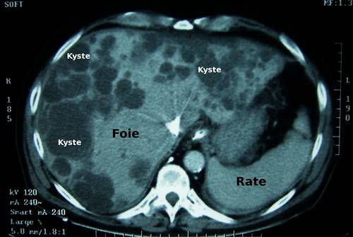 La Polykystose Hépatique | Association PolyKystose France